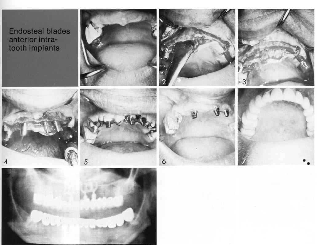 p 201 Maxillary intratooth endosteal blade implants