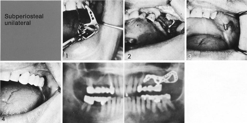 p 225 Maxillary partial subperiosteal implant support