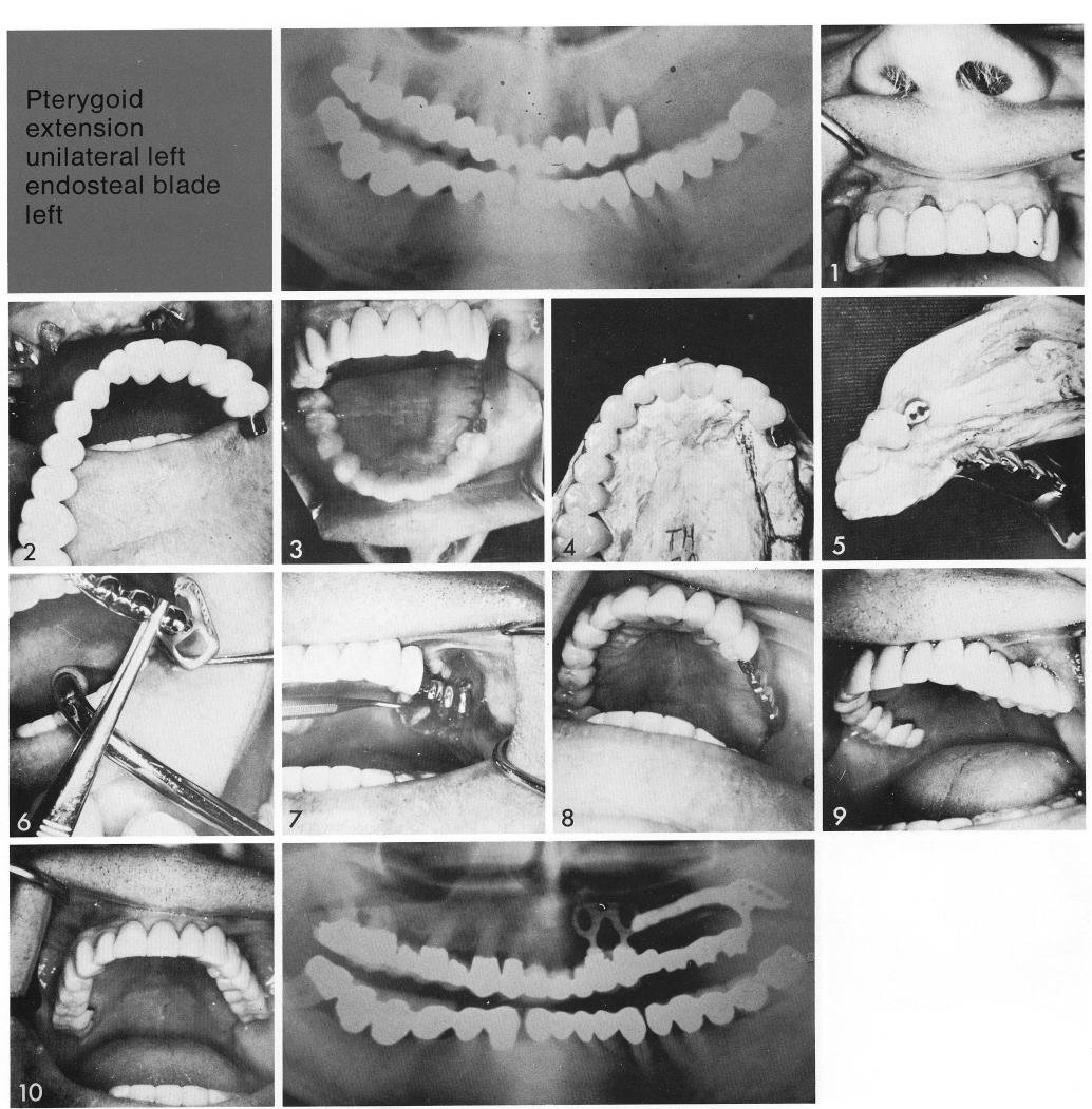 p 243 Maxillary pterygoid extension implant and endosteal blade implant