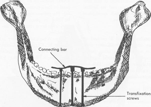 p 164 Techniques of vertical transfixation of endosseous implant screw