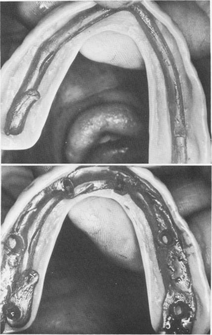 p 276 Subperiosteal implant armamentarium for maxilla and mandible