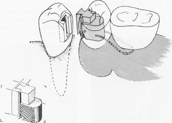 p 286 Crismani implant prothesis attachment on mandible