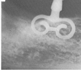 p 464 Pictures showing insertion of dental blade implant