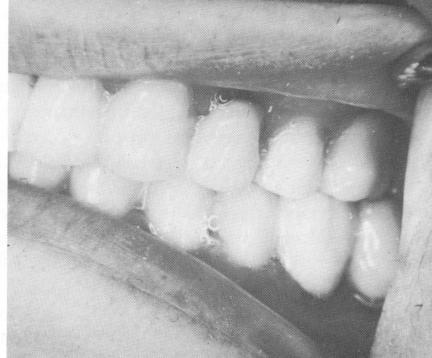 p 464 Pictures showing insertion of dental blade implant