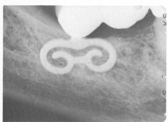 p 464 Pictures showing insertion of dental blade implant