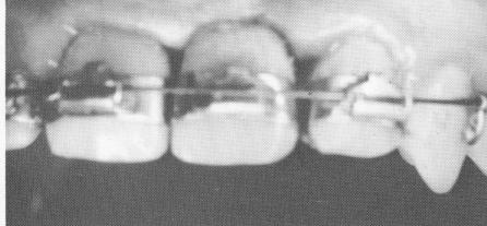p 657 Single tooth blade implant supported by labial arch appliance