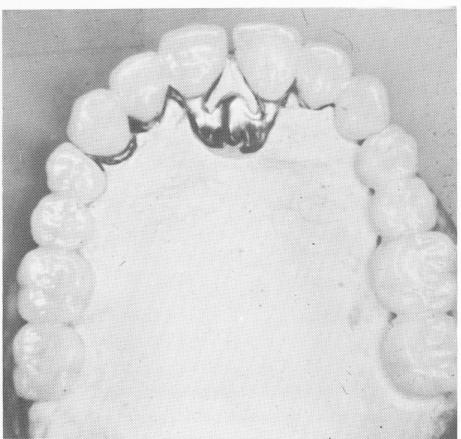 p 660 Maxillary arch with anterior diastema restored with blade implants